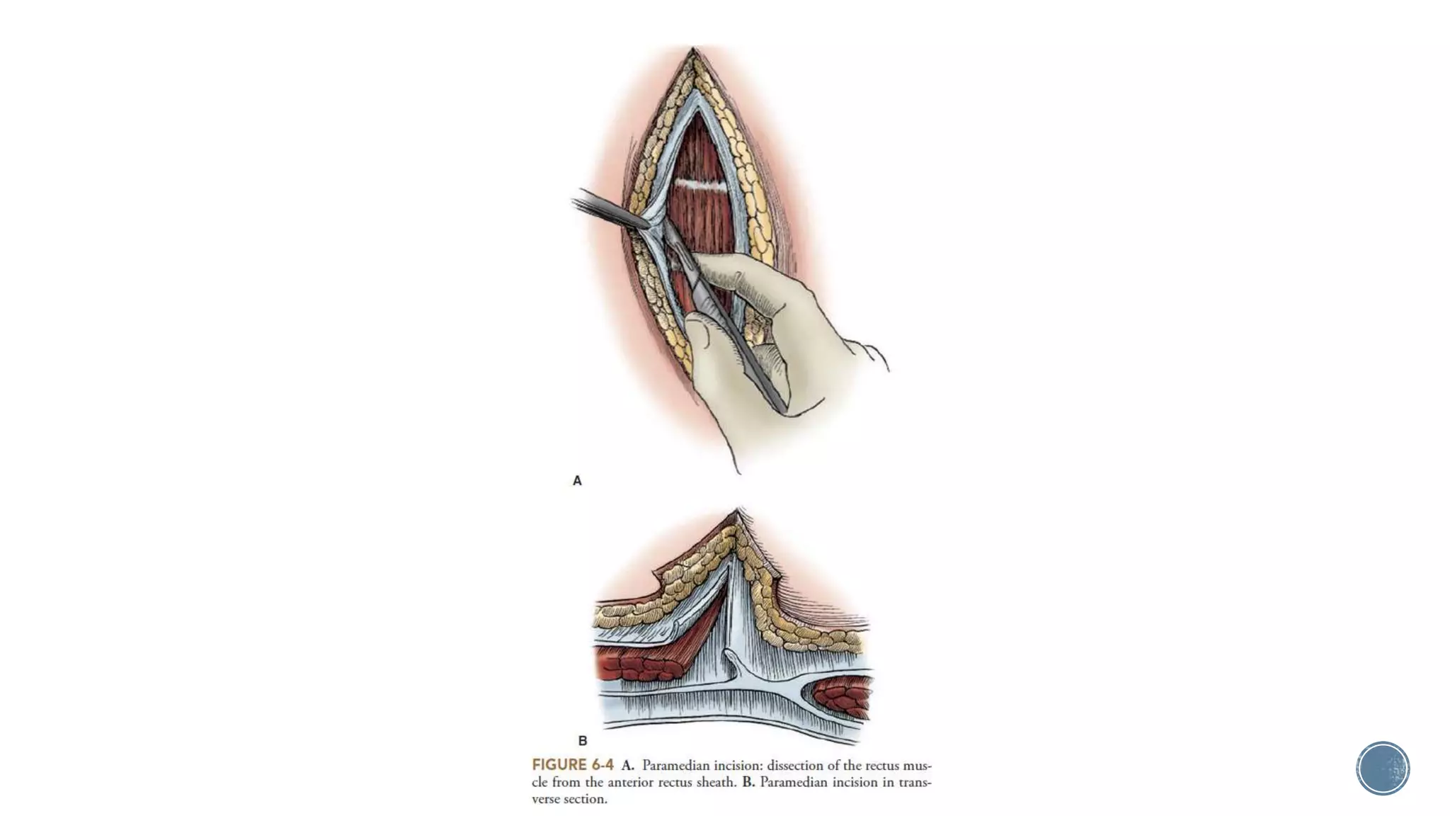 Abdominal Incisions.pptx