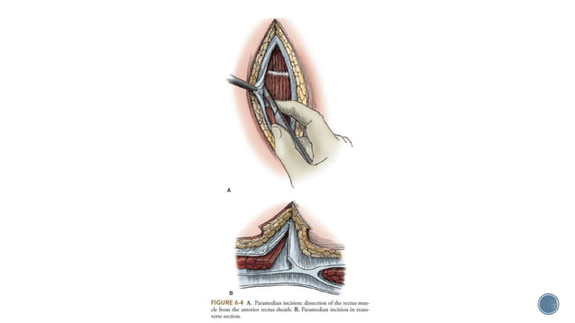 Abdominal Incisions.pptx | Death, Injury, or Military Conflict ...