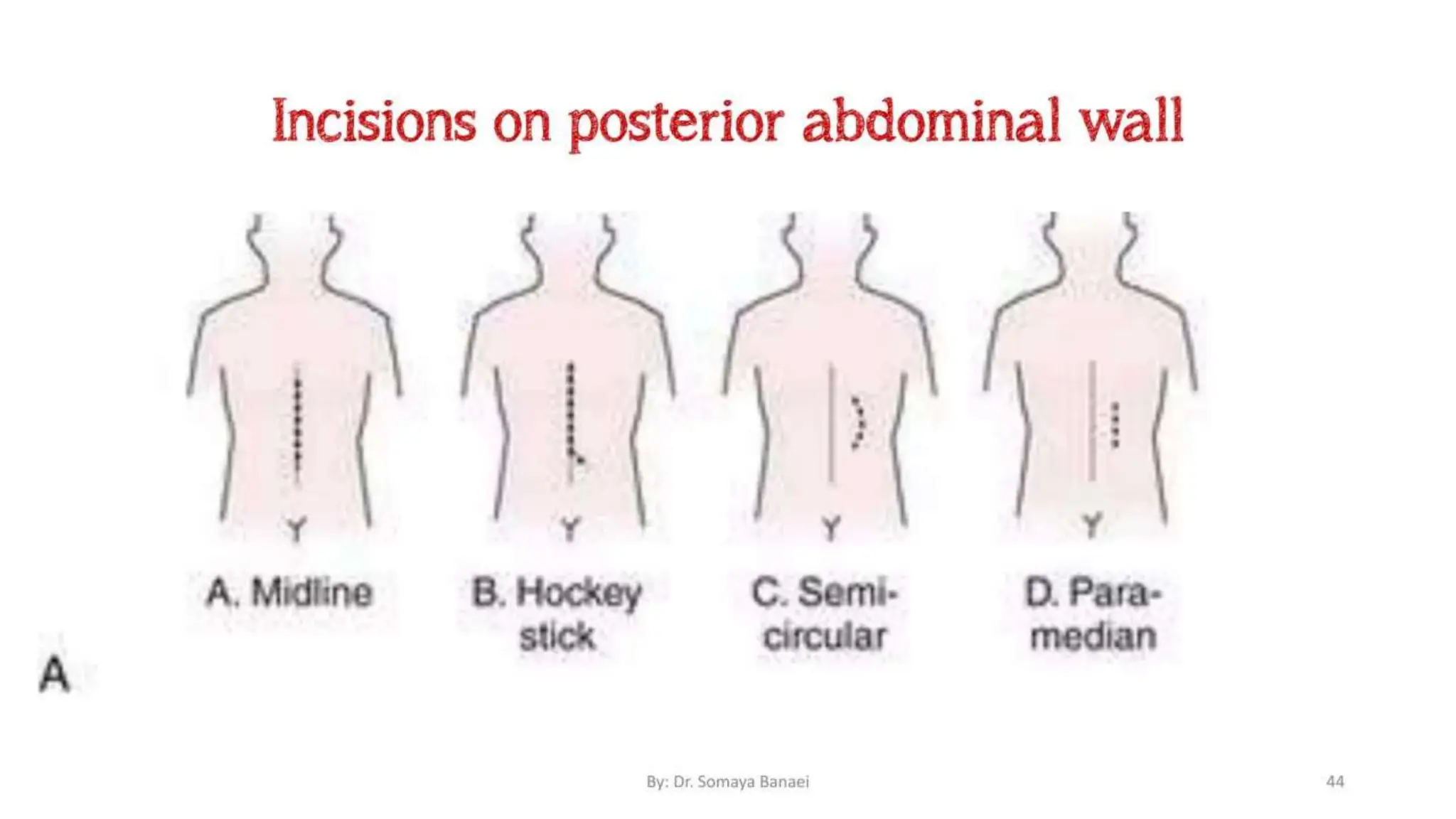 Abdominal Incisions for medical students | PPT