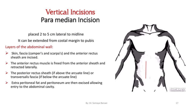 Abdominal Incisions for medical students | PPTX