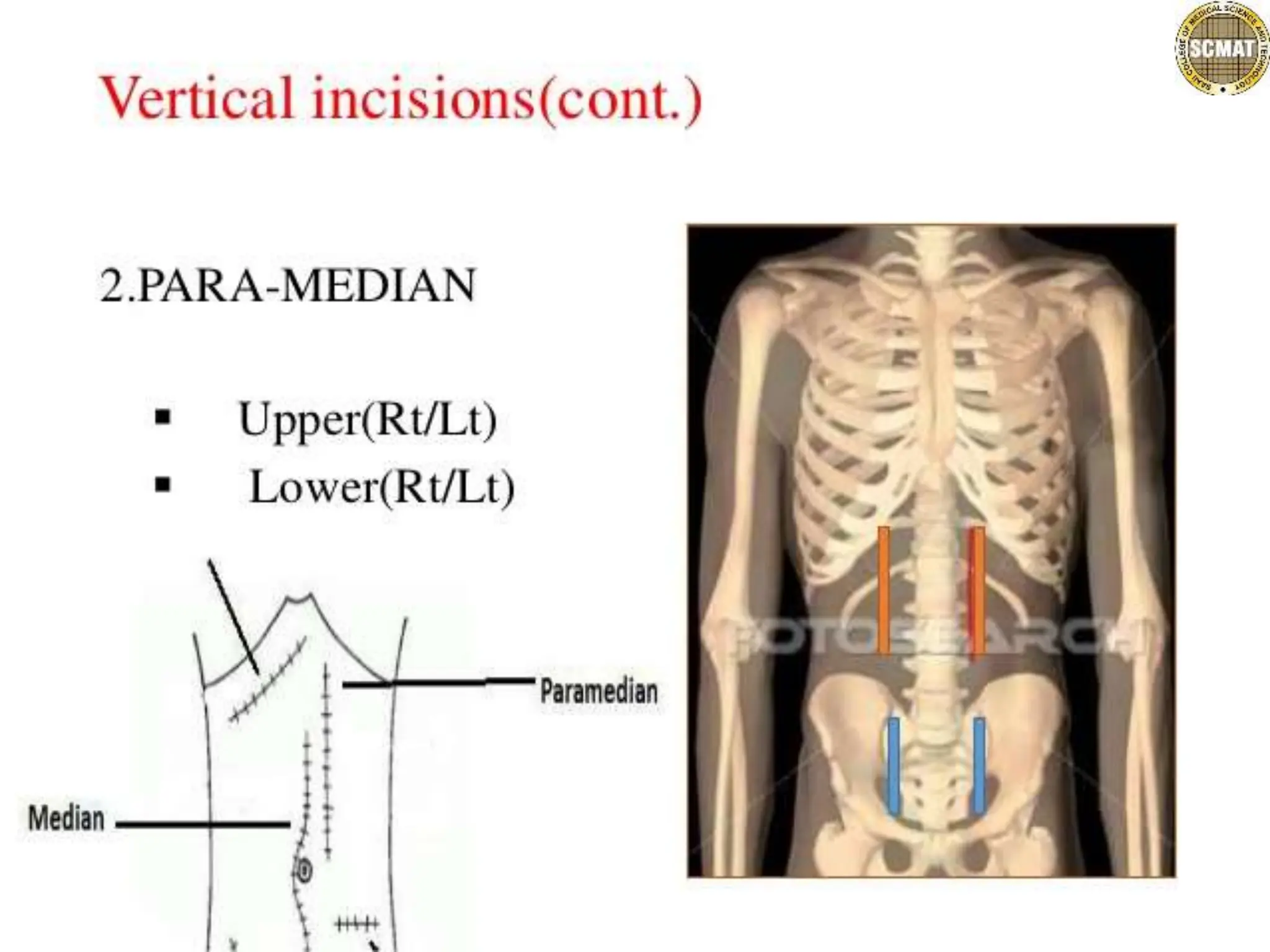 abdominal incisions.pptx
