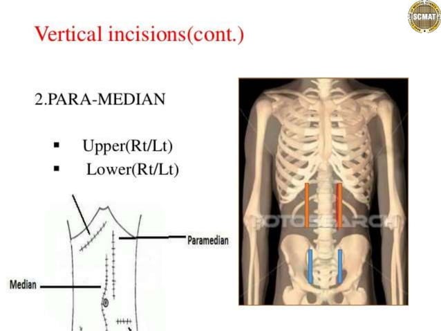 abdominal incisions.pptx