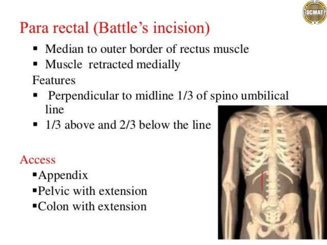 abdominal incisions.pptx