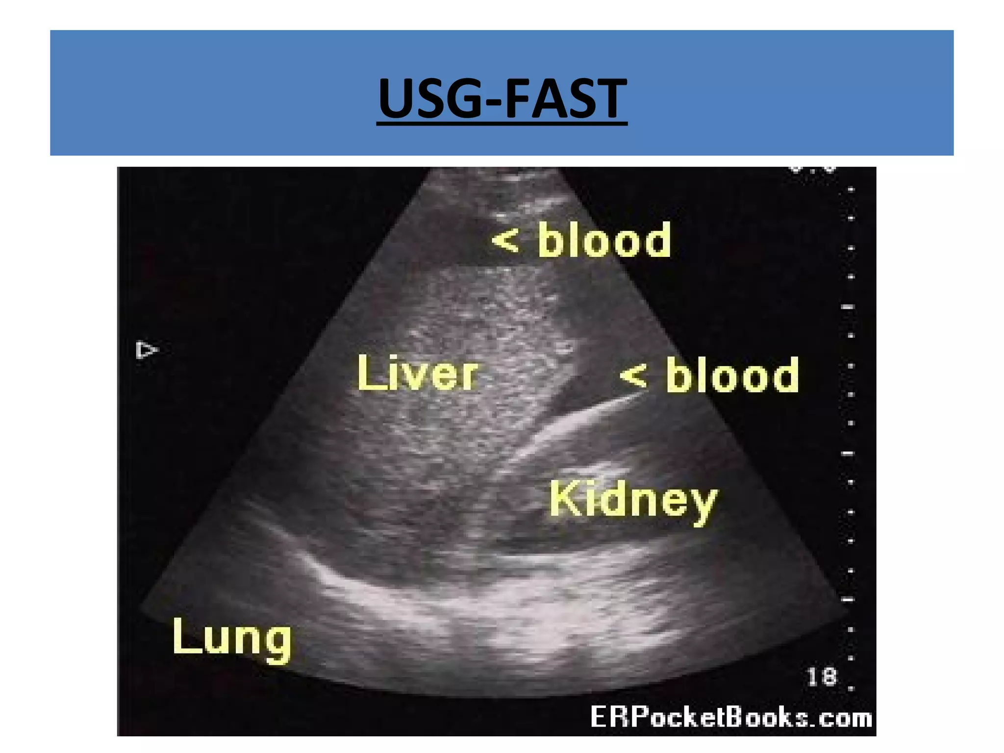 Abdominal injuries | PPT