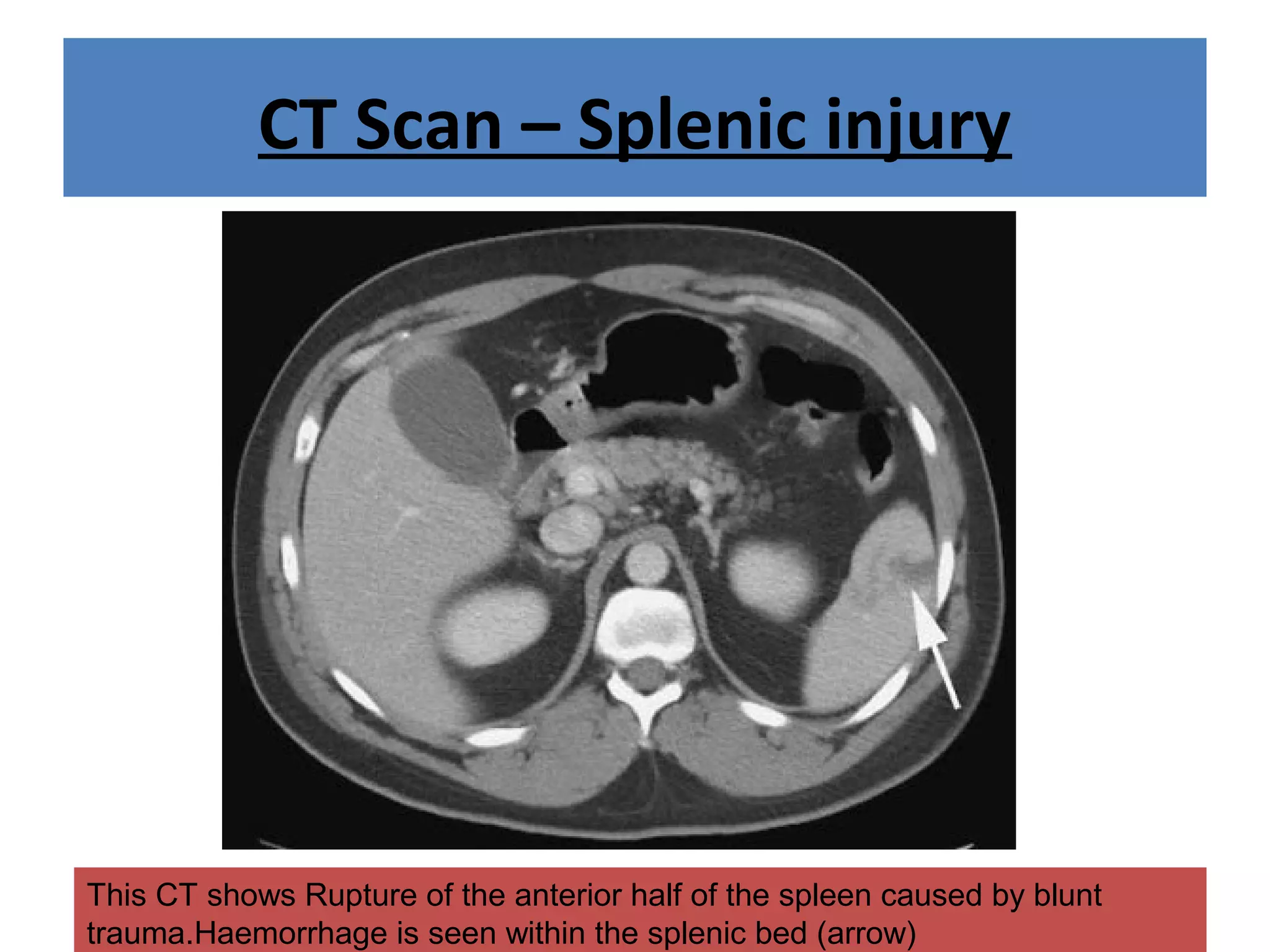 Abdominal injuries | PPT