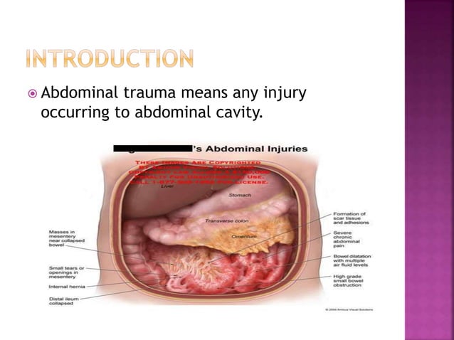 Abdominal injury | PPTX