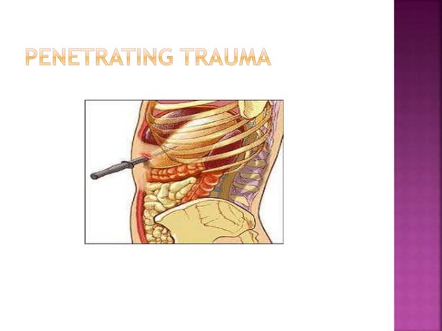 Abdominal injury | PPTX