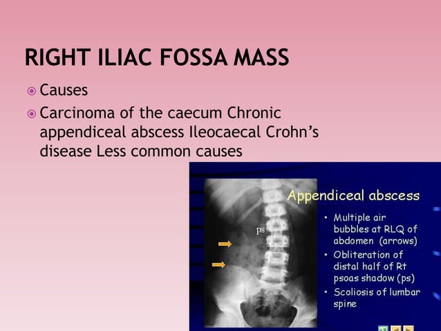 Abdominalmass 140808145556 Phpapp01 3 Ppt