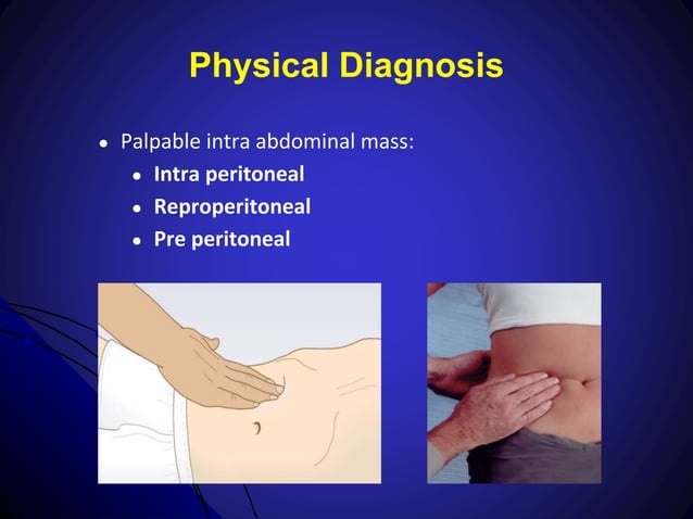 Abdominal mass .pptx