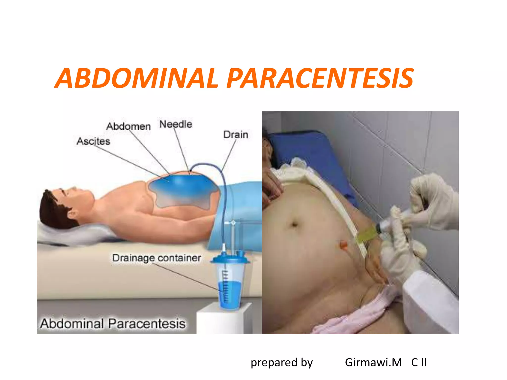 Abdominal paracentesis | PPTX