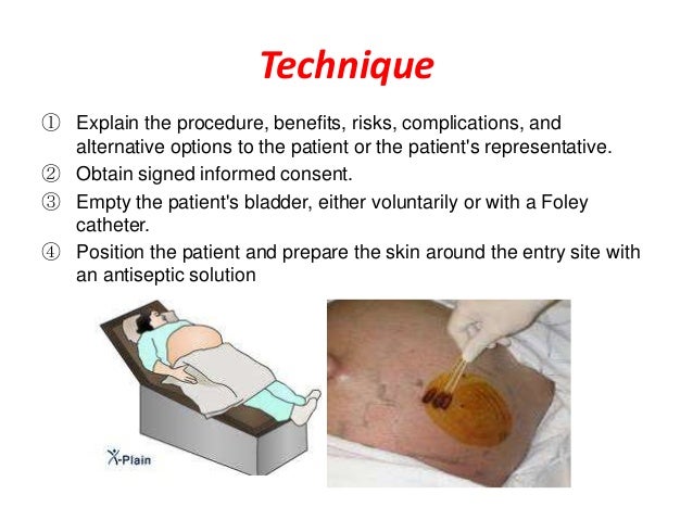 Abdominal paracentesis