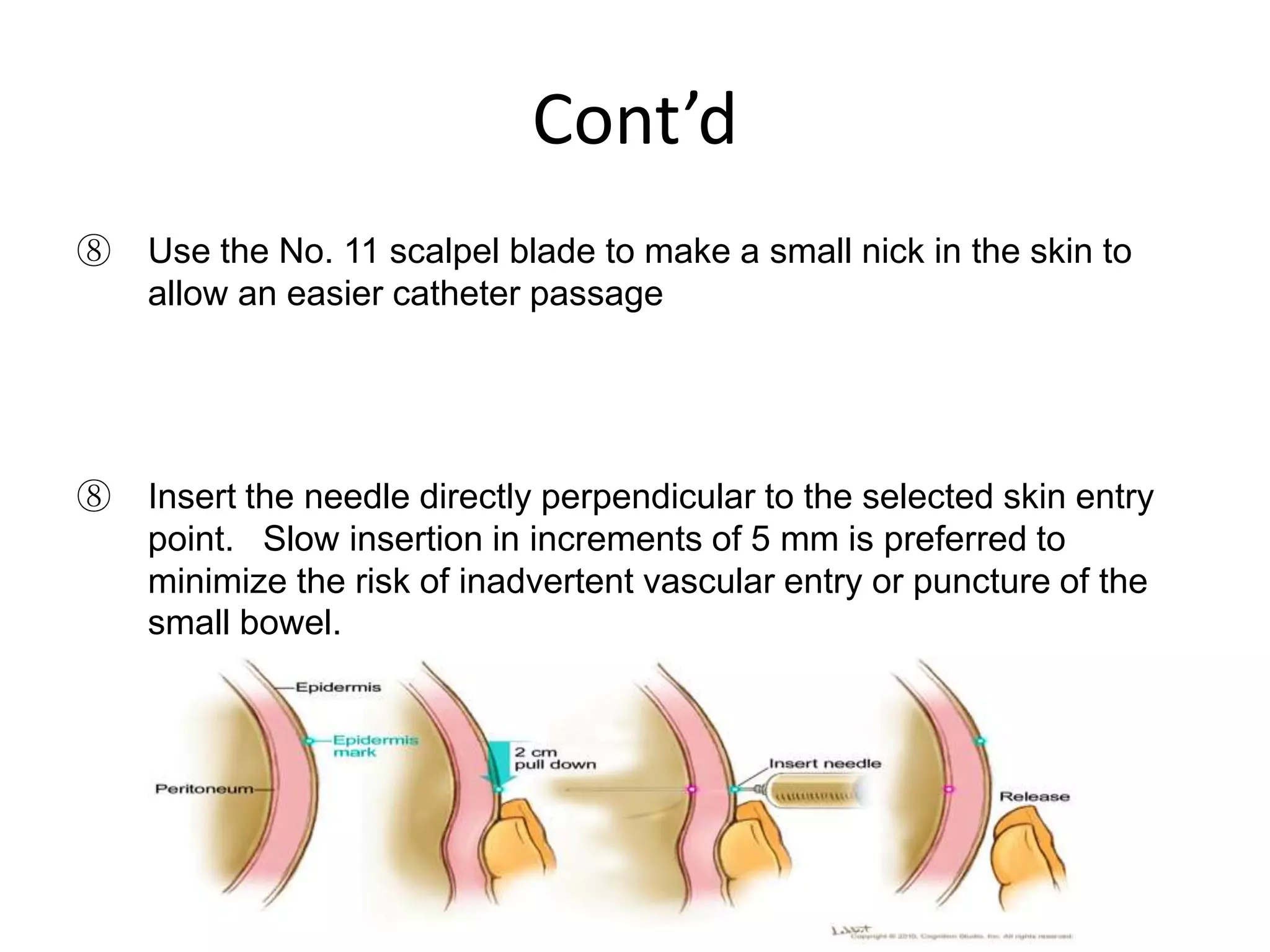 Abdominal paracentesis | PPTX | Blood Disorders | Diseases and Conditions