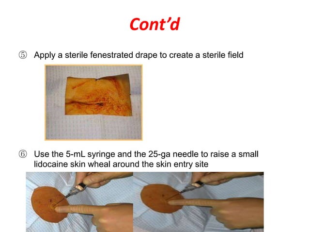 Abdominal paracentesis | PPT