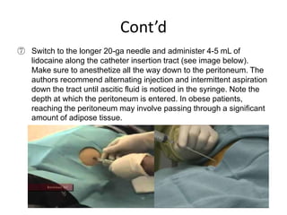 Abdominal paracentesis | PPTX