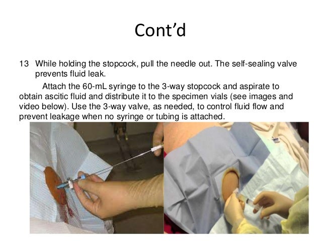 Abdominal paracentesis