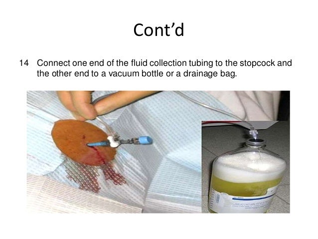 Abdominal paracentesis