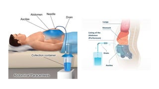 Abdominal Paracentesis - Nursing Role | PPTX