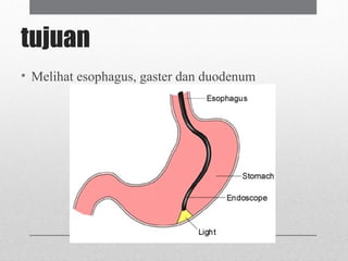 ABDOMINAL PARACENTESIS & OGDS | PPT