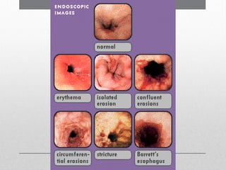 ABDOMINAL PARACENTESIS & OGDS | PPT