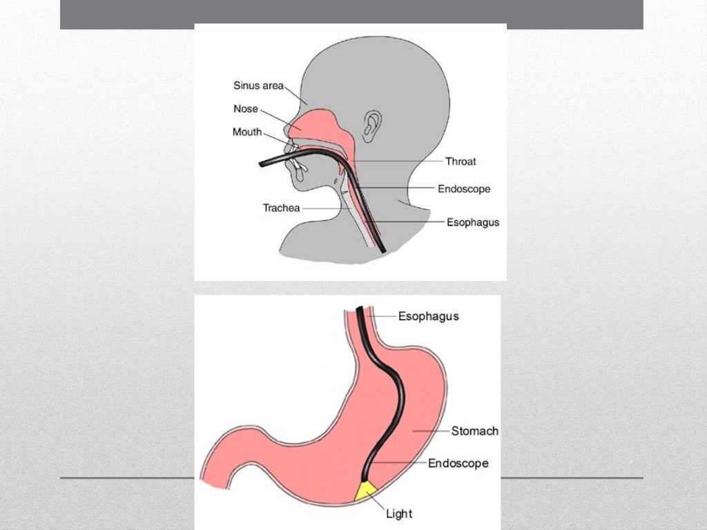 ABDOMINAL PARACENTESIS & OGDS