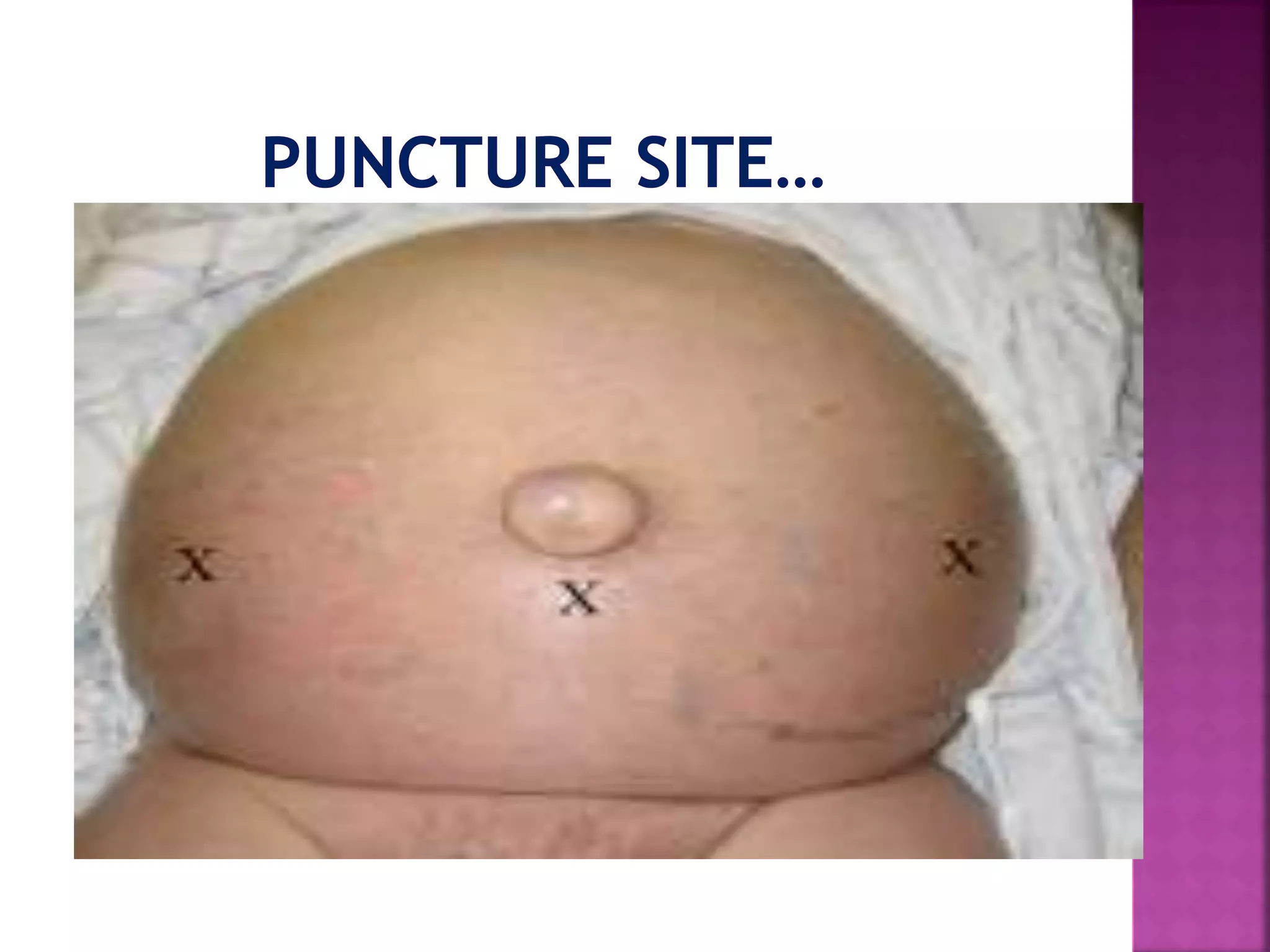 Abdominal paracentesis | PPTX