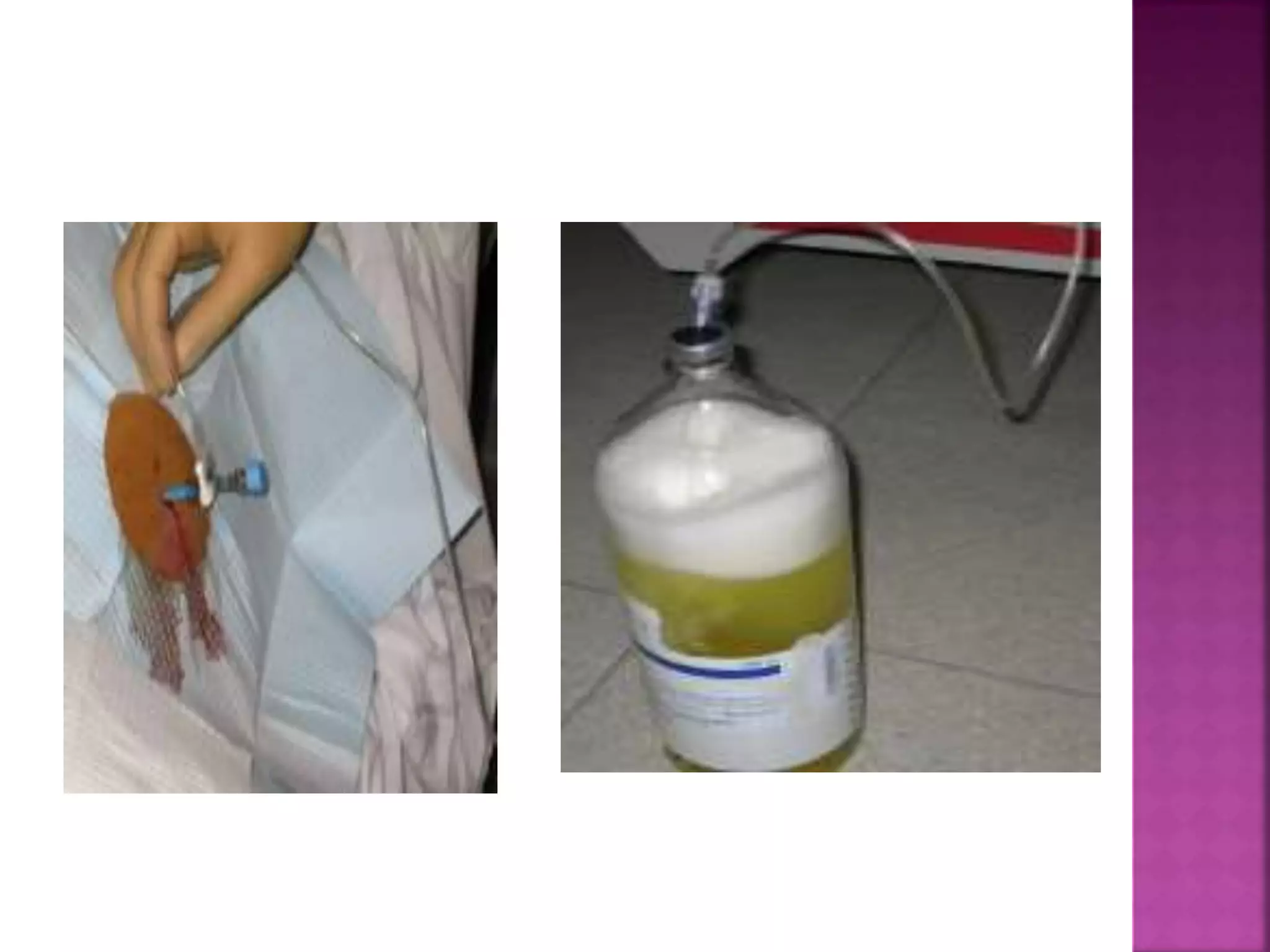 Abdominal paracentesis | PPTX