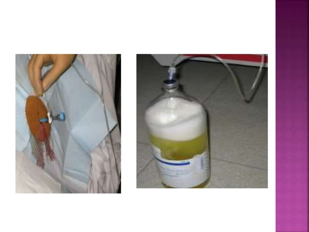 Abdominal paracentesis | PPTX | Lung and Respiratory Health | Diseases ...