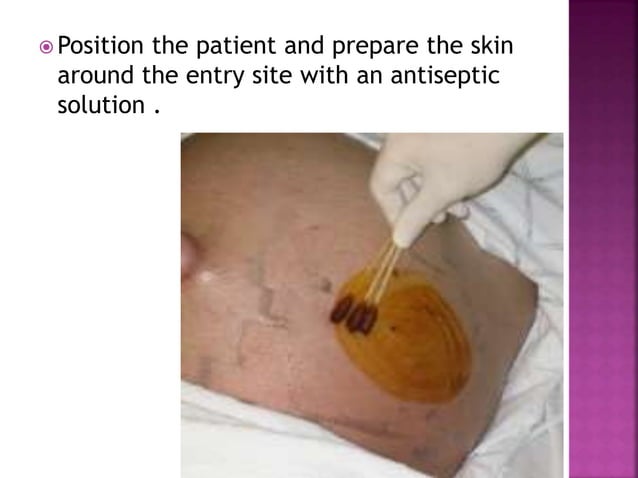 Abdominal paracentesis