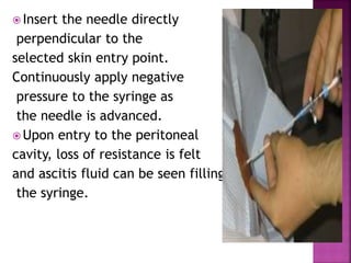 Paracentesis Procedure
