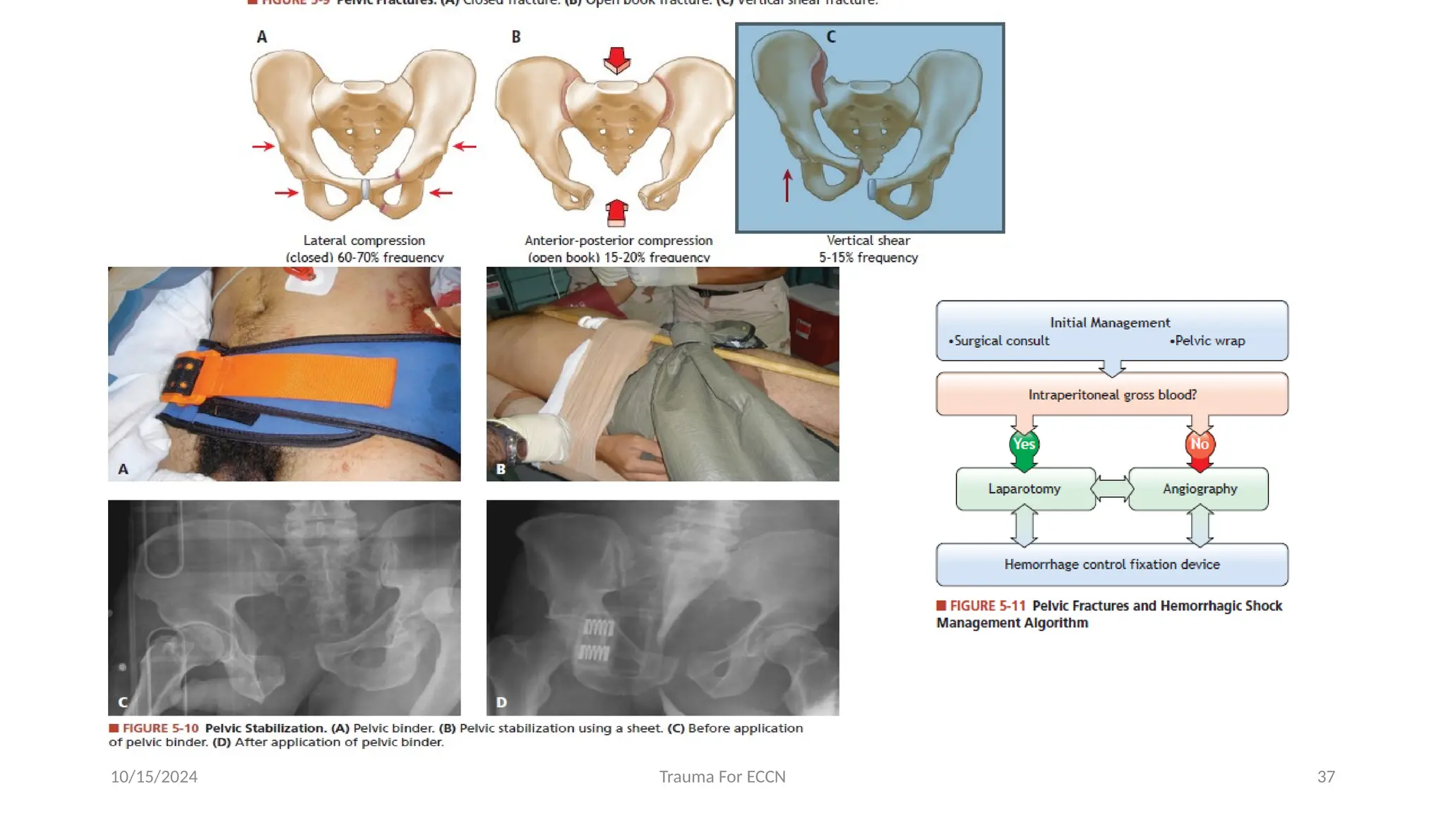 abdominal pelvic trauma and its emergency managment.pptx