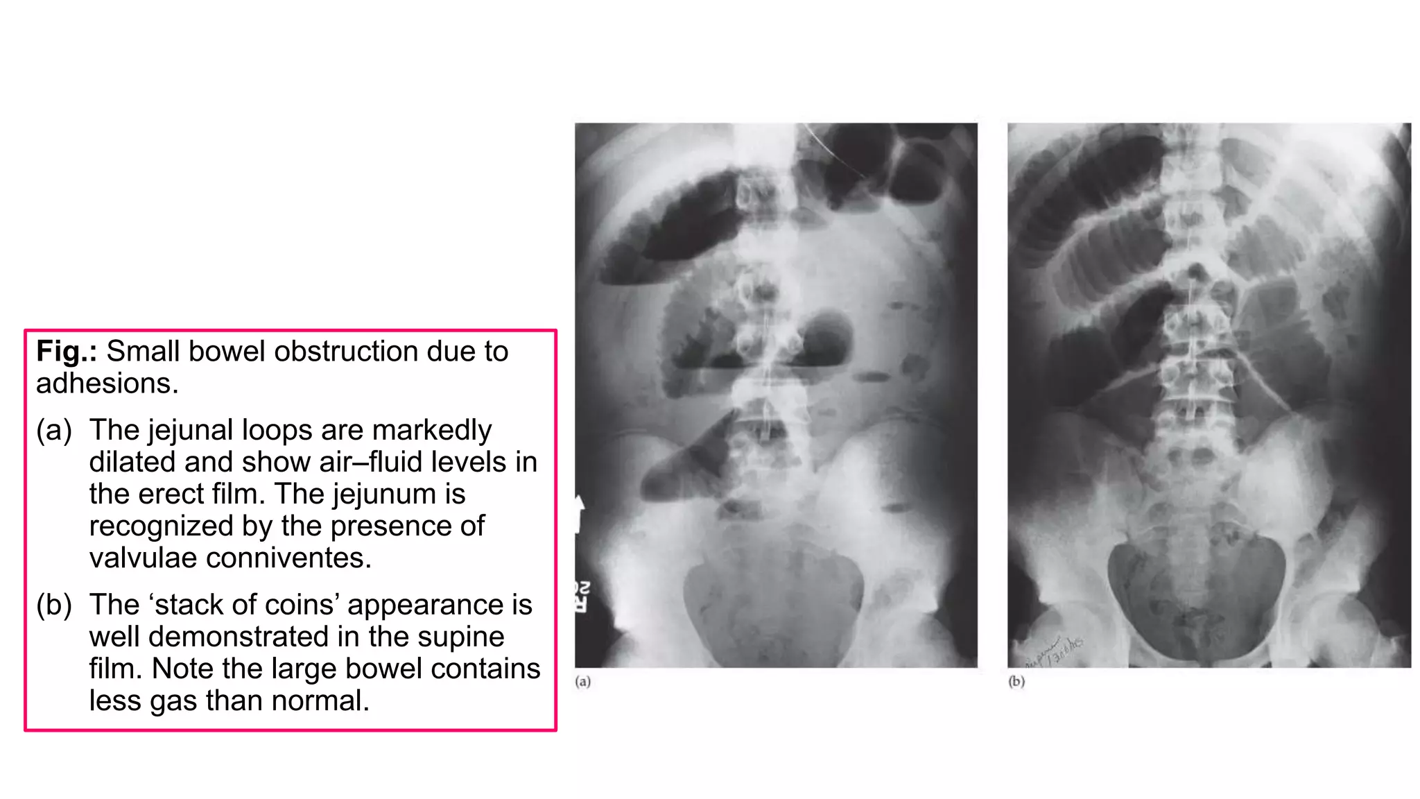 Abdominal Plain.pptx