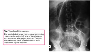 Abdominal Plain.pptx