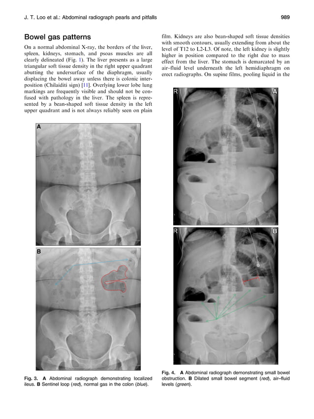 Abdominal radiograph | PDF