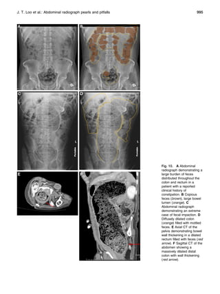 Abdominal radiograph | PDF