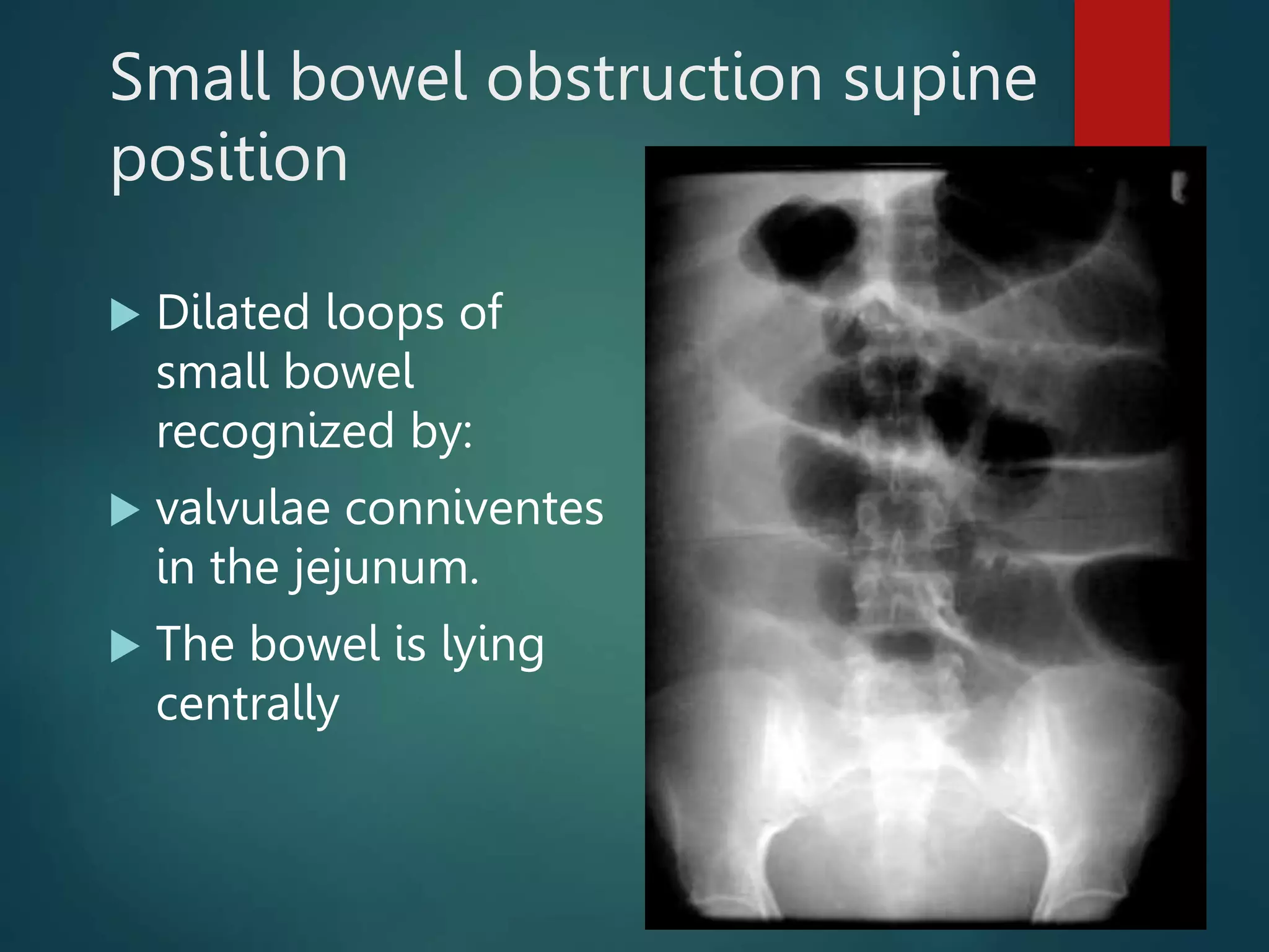 ABDOMINAL RADIOGRAPHY.pptx.pptx