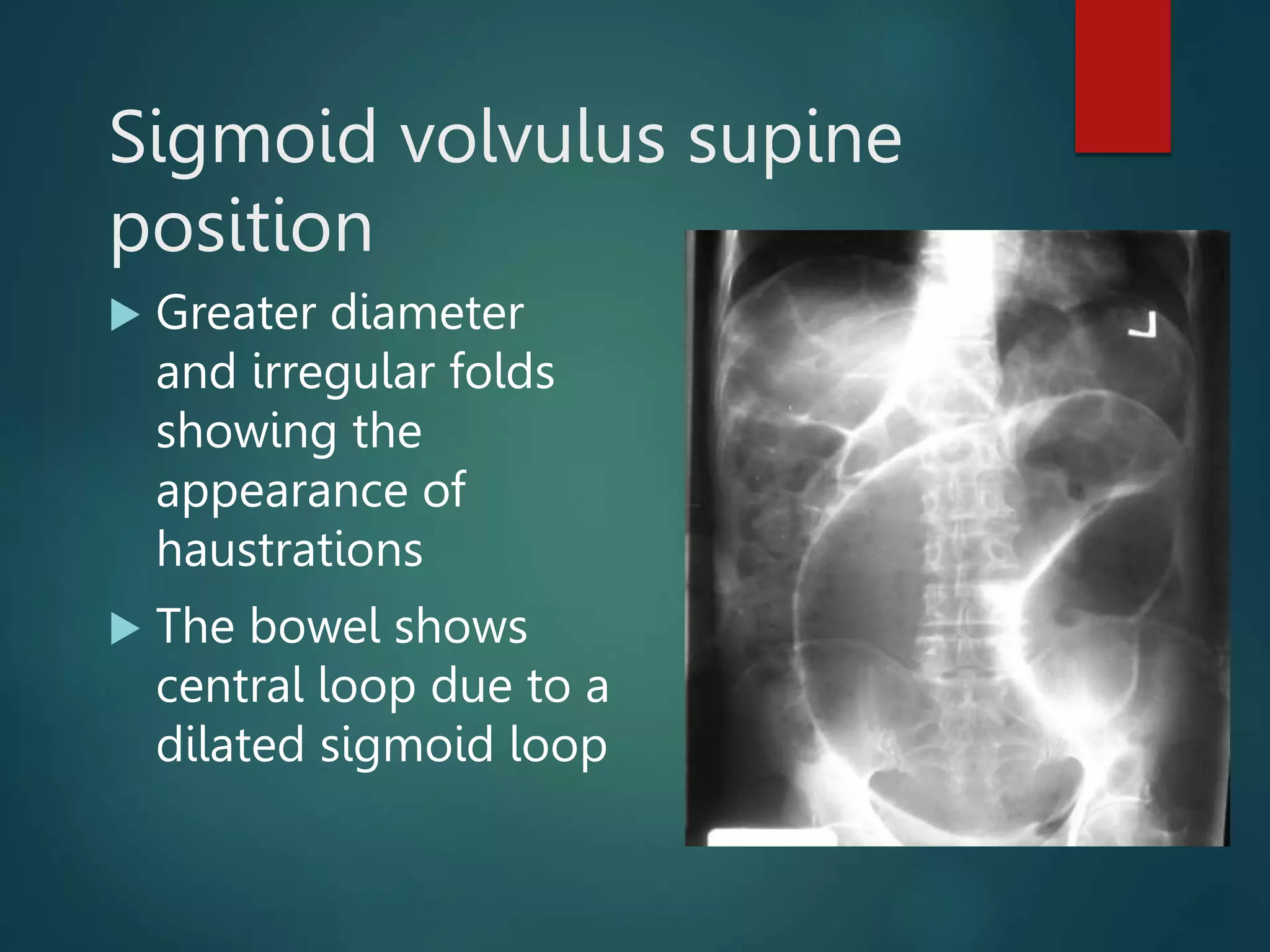 ABDOMINAL RADIOGRAPHY.pptx.pptx