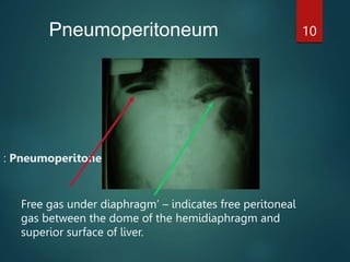 ABDOMINAL RADIOGRAPHY.pptx.pptx