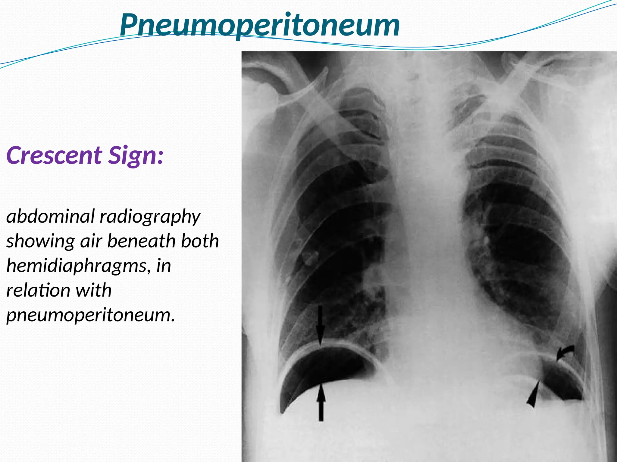 Abdominal Radiology - x-rays of abdomen | PPTX