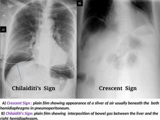 Abdominal Radiology - x-rays of abdomen | PPTX