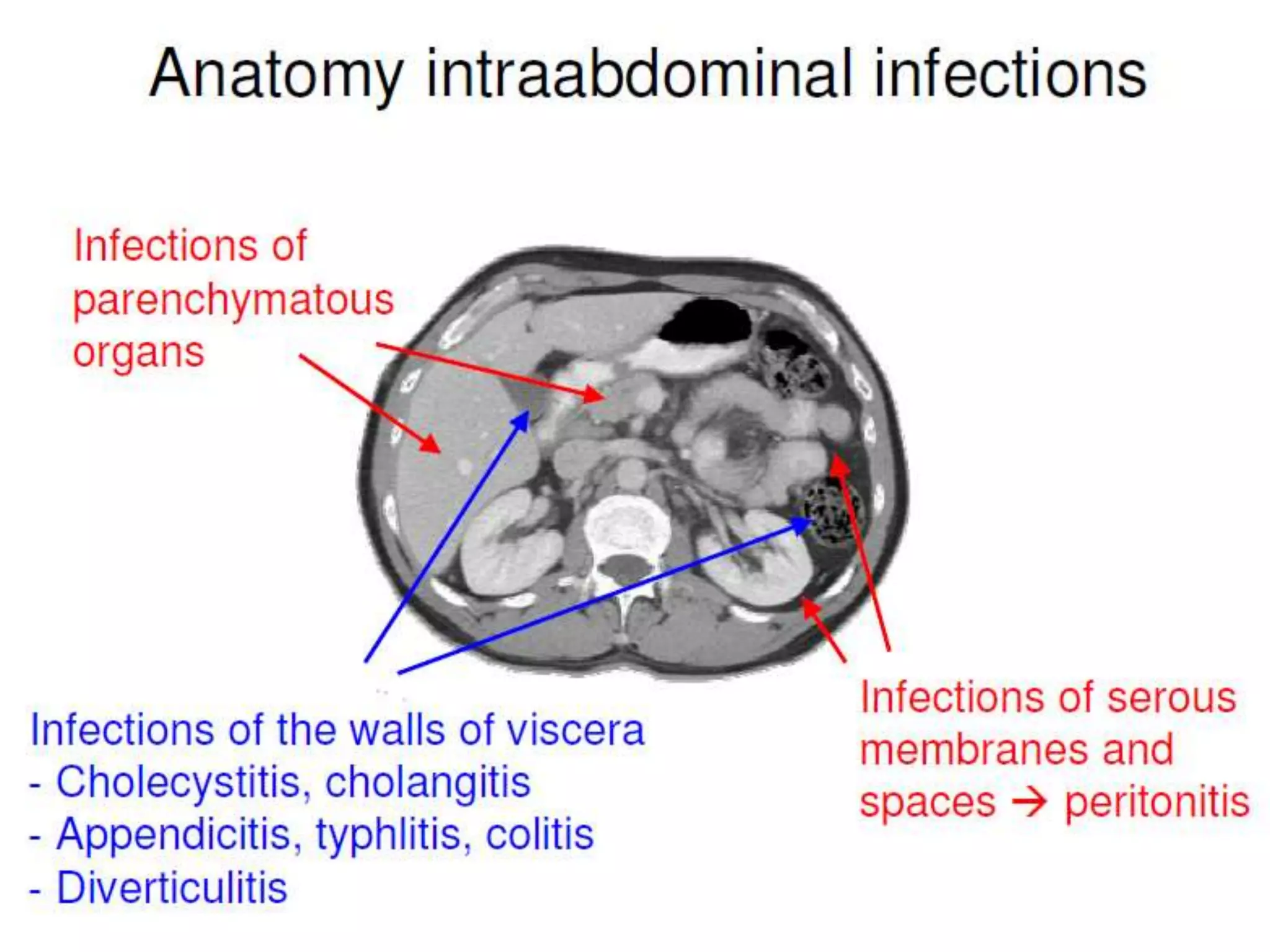 Abdominal Sepsis and Peritonitis | PPTX