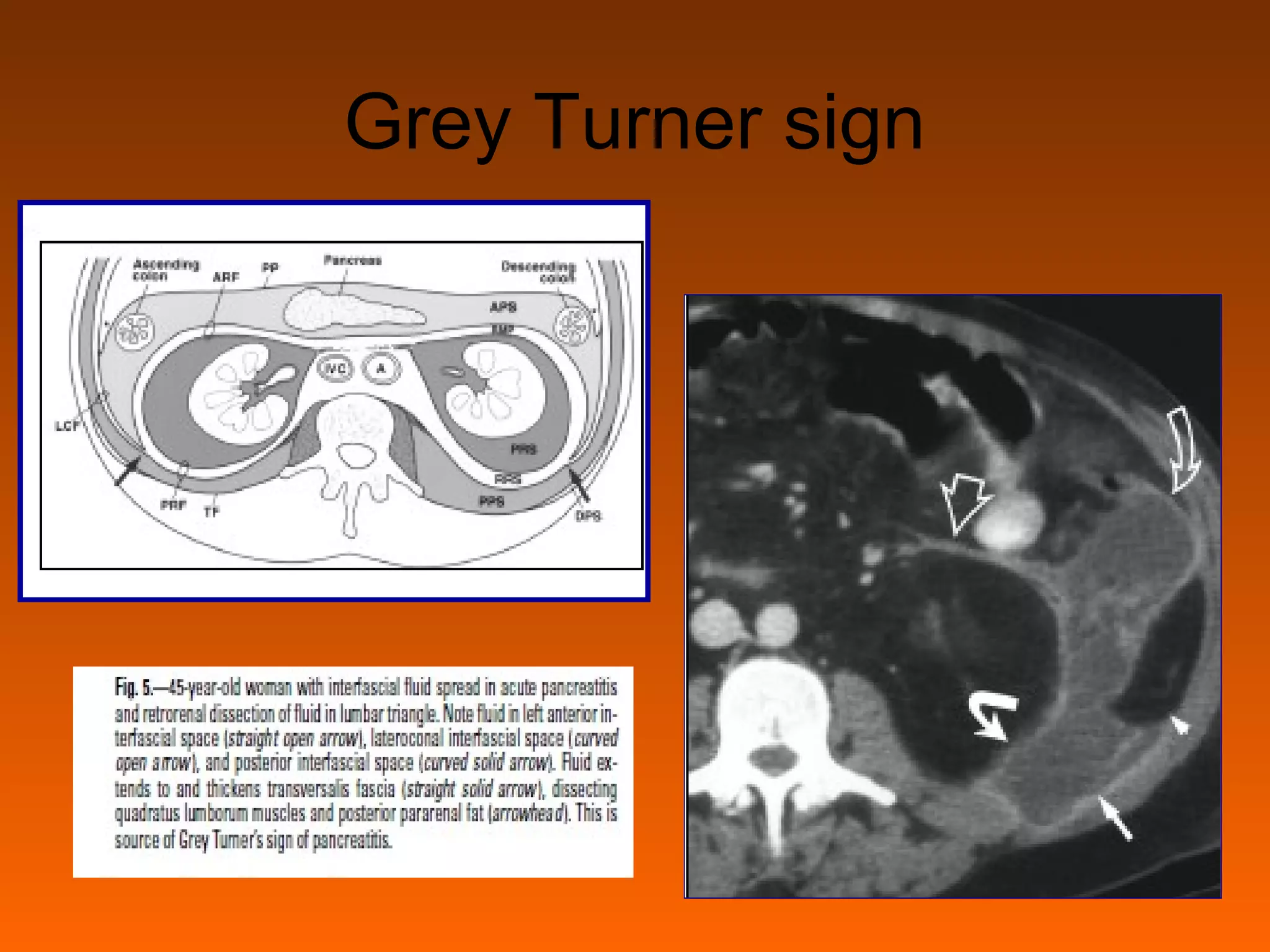 Radiological anatomy of abdominal spaces ...pathway of tumor and ...