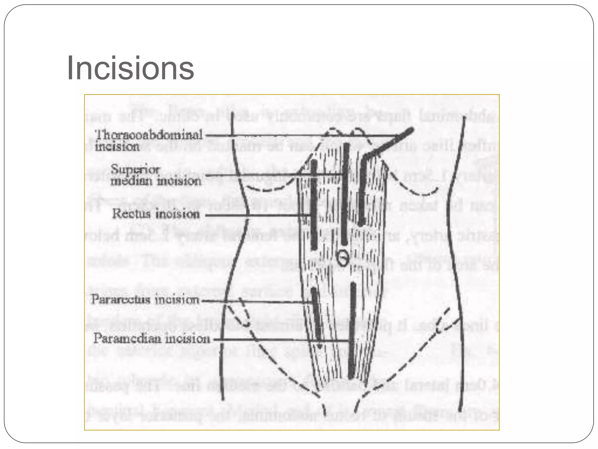 Abdominal surgeries | PPTX