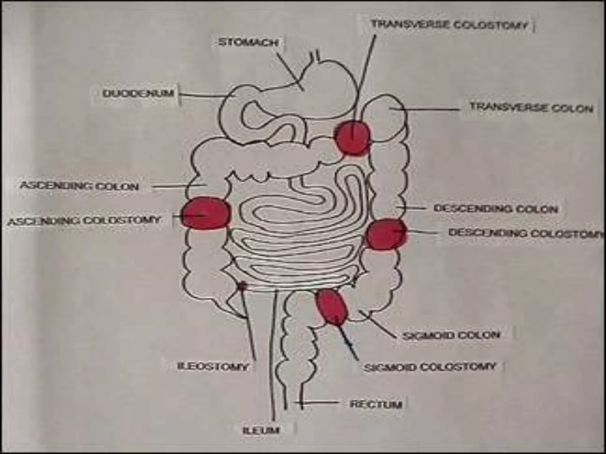 Abdominal surgeries | PPTX