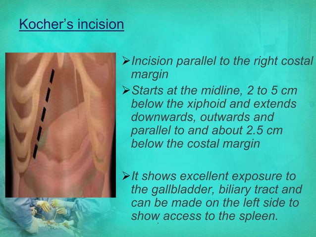 Abdominal surgery | PPT | Free Download