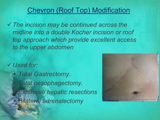 Abdominal surgery | PPTX