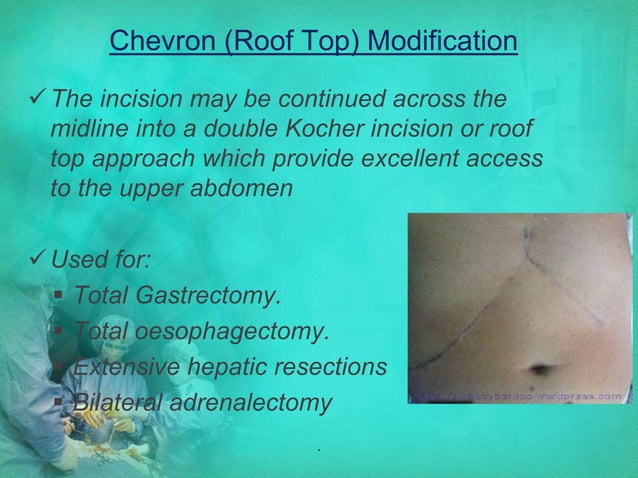 Abdominal surgery | PPTX