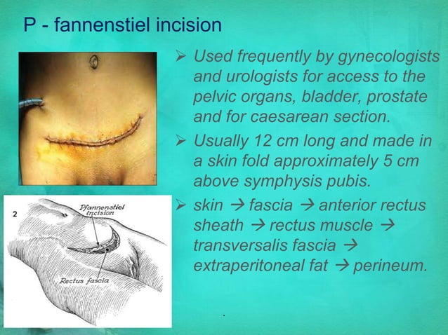 Abdominal surgery | PPTX
