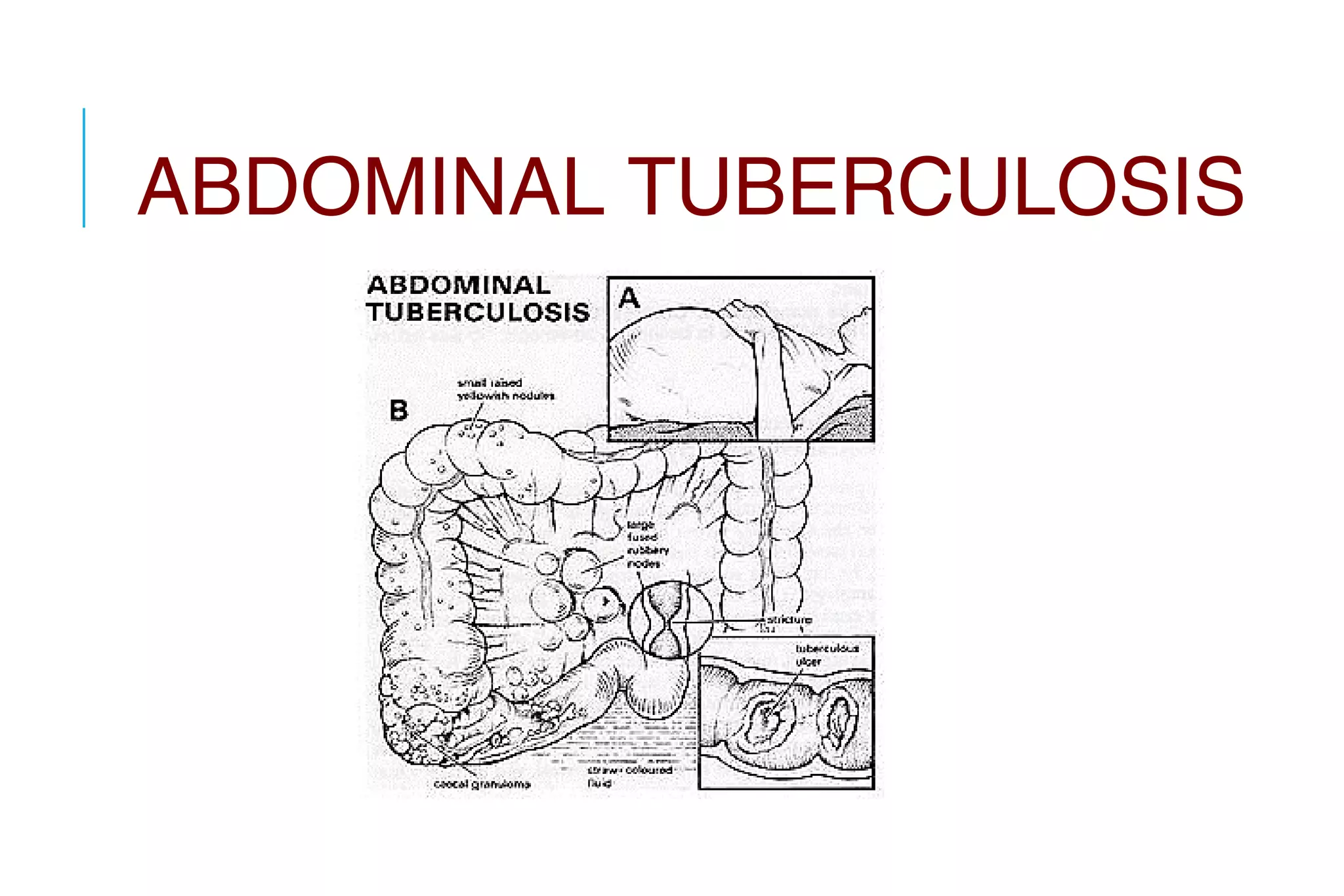 Abdominal tuberculosis | PPT