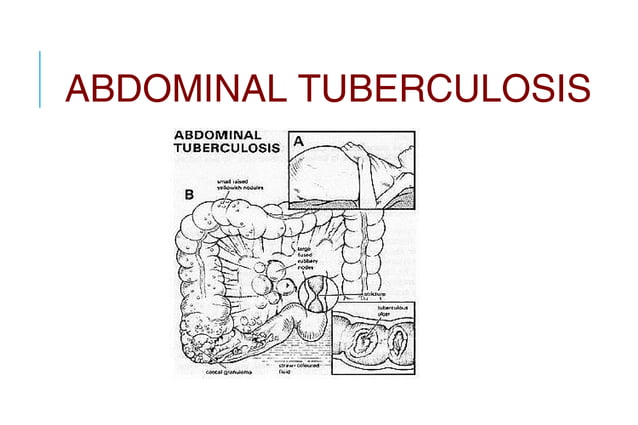 Abdominal tuberculosis | PPT