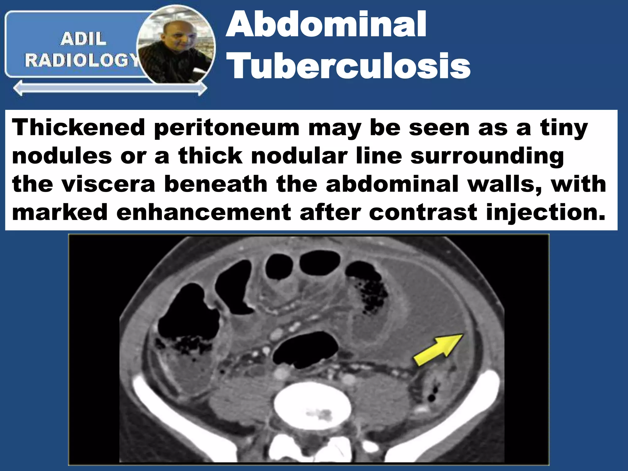 Abdominal tb | PPTX